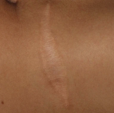 Littekens - Medi Skin Care