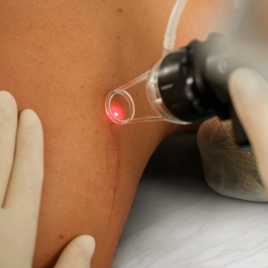Keloïd litteken behandeling - Medi Skin Care