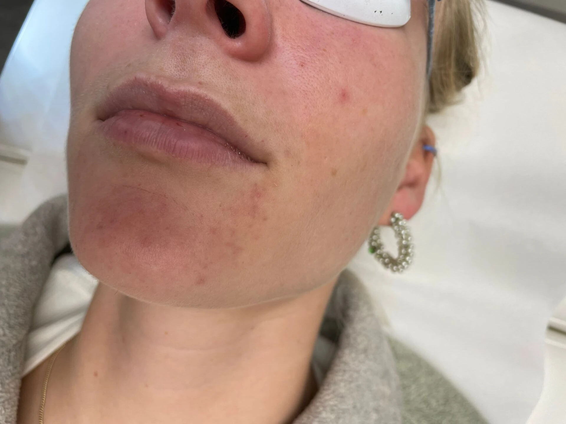 Acné-littekens - Medi Skin Care